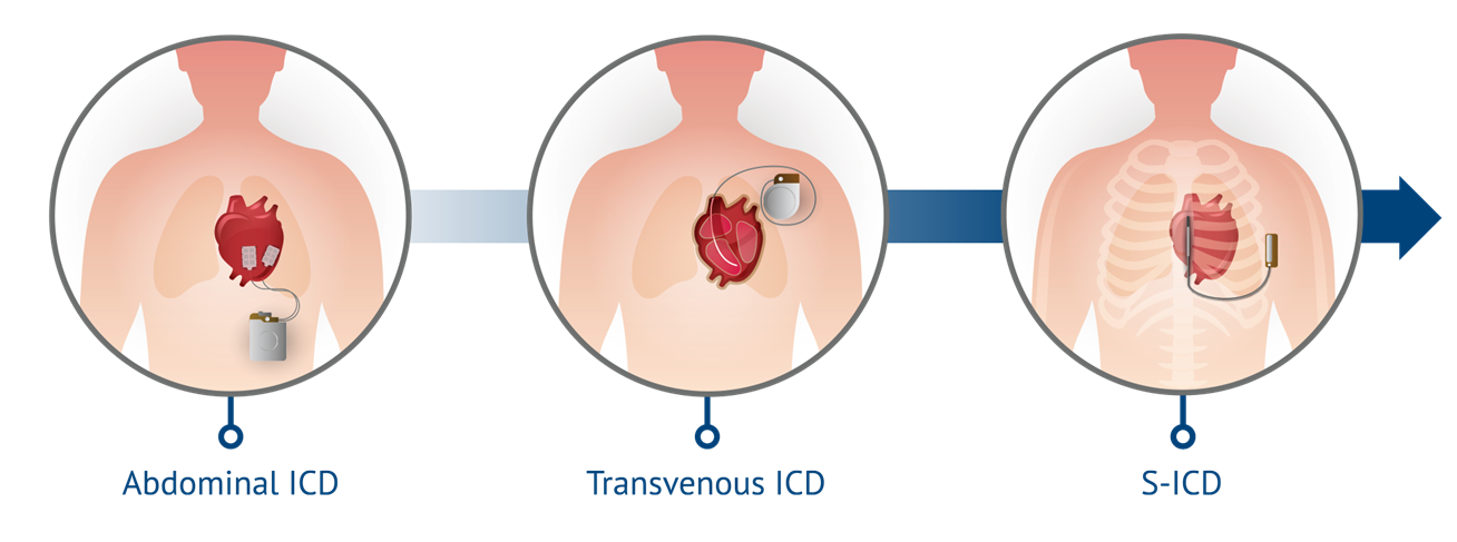 EMBLEM™ MRI S-ICD System | Why S-IDC Therapy? - Boston Scientific